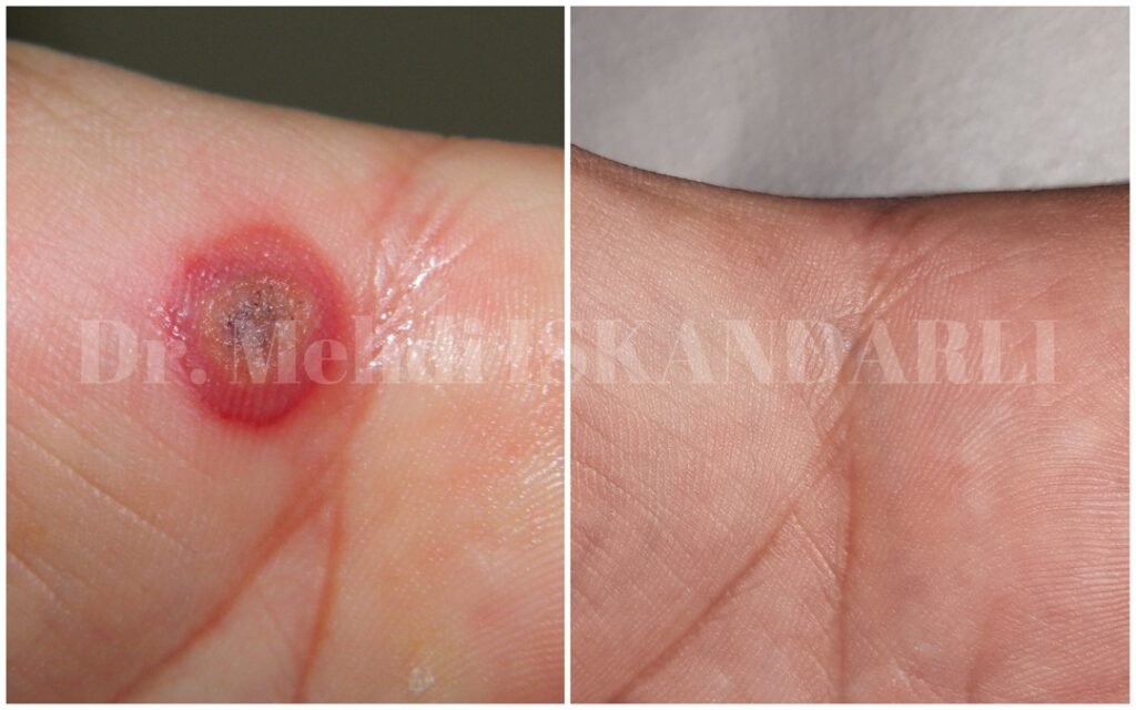 Ziyillərin müalicəsi necə aparılır ? | Dermatoloq Mehdi İskəndərli