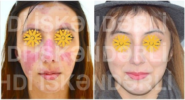 Qırmızı qurd eşənəyi | Əlamətləri və Müalicəi | Dermatoloq şərhi