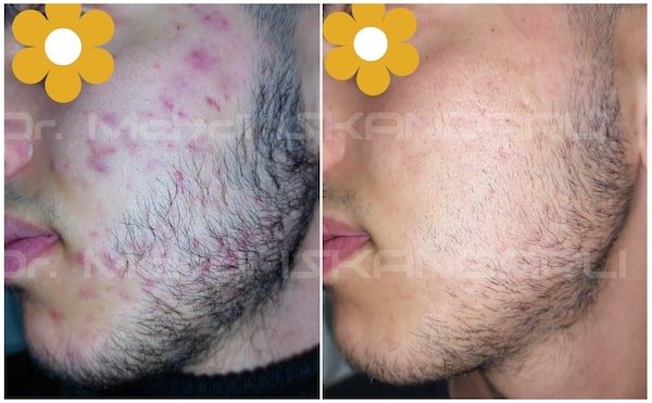 Sızanaq nədir? | Akne səbəbləri, növləri və müalicəsi