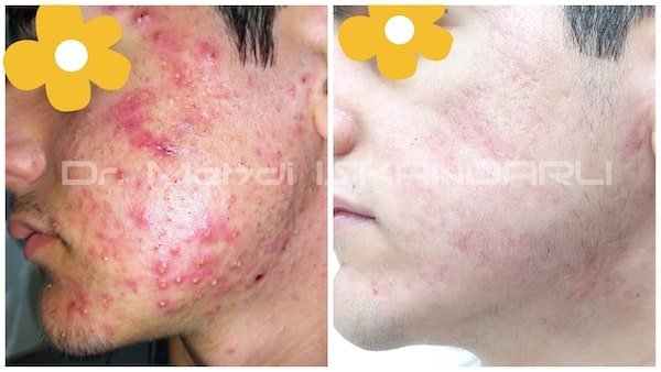 Sızanaq nədir? | Akne səbəbləri, növləri və müalicəsi